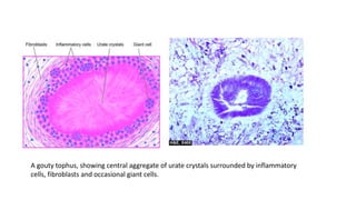 Rheumatoid arthritis, gout, tenosynovial giant cell tumour - revision | PPT
