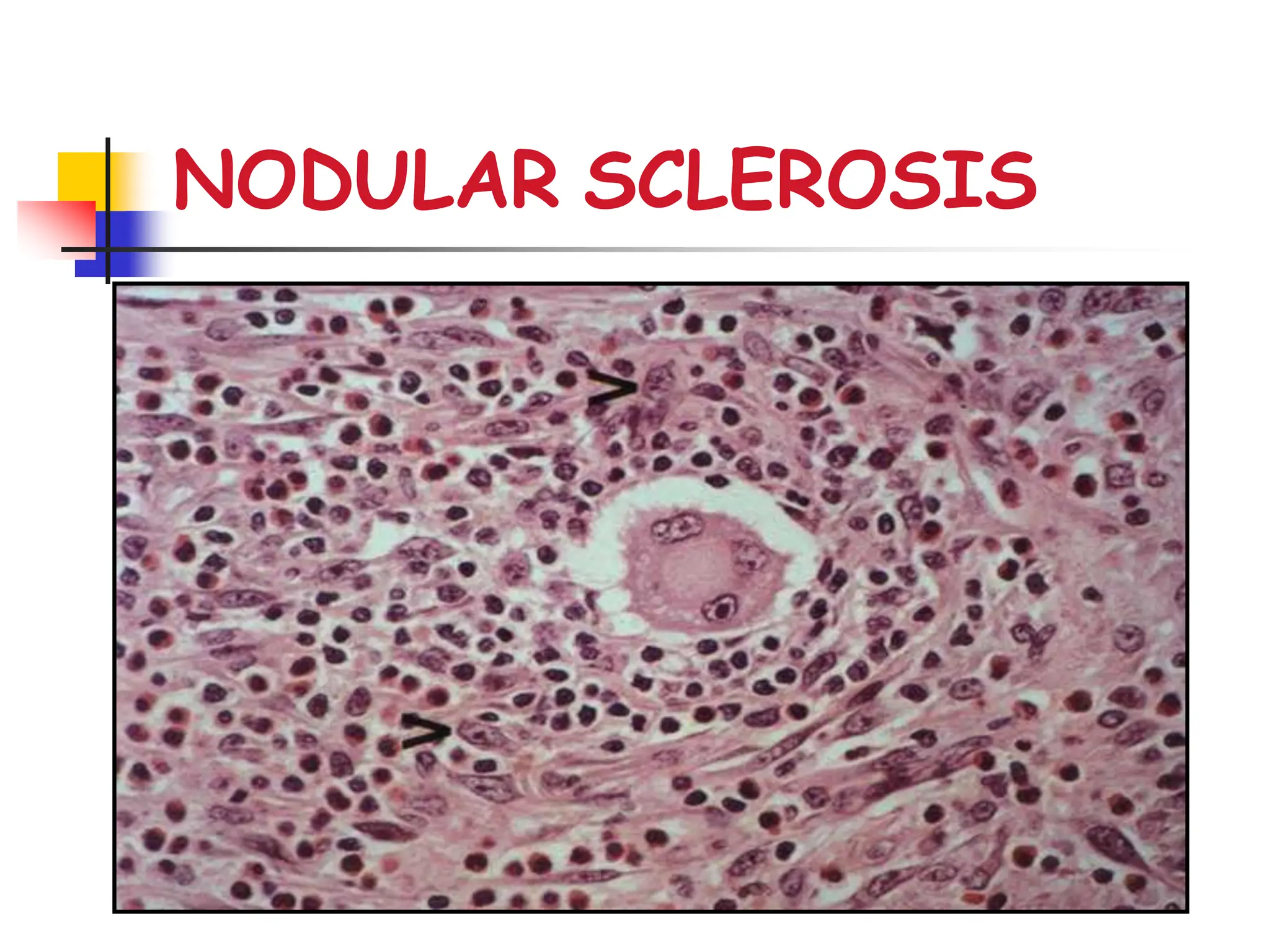 CLASSIFICATION DEFINITION & HODGKIN LYMPHOMA FOR BDS | PPT