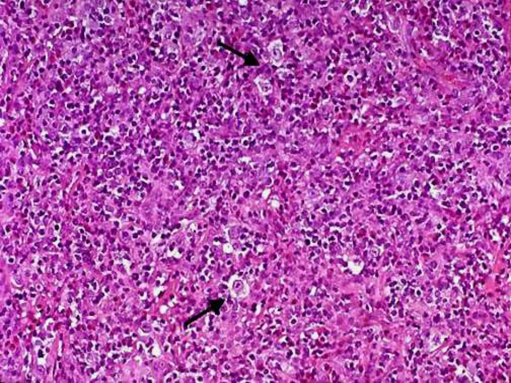 CLASSIFICATION DEFINITION & HODGKIN LYMPHOMA FOR BDS | PPT