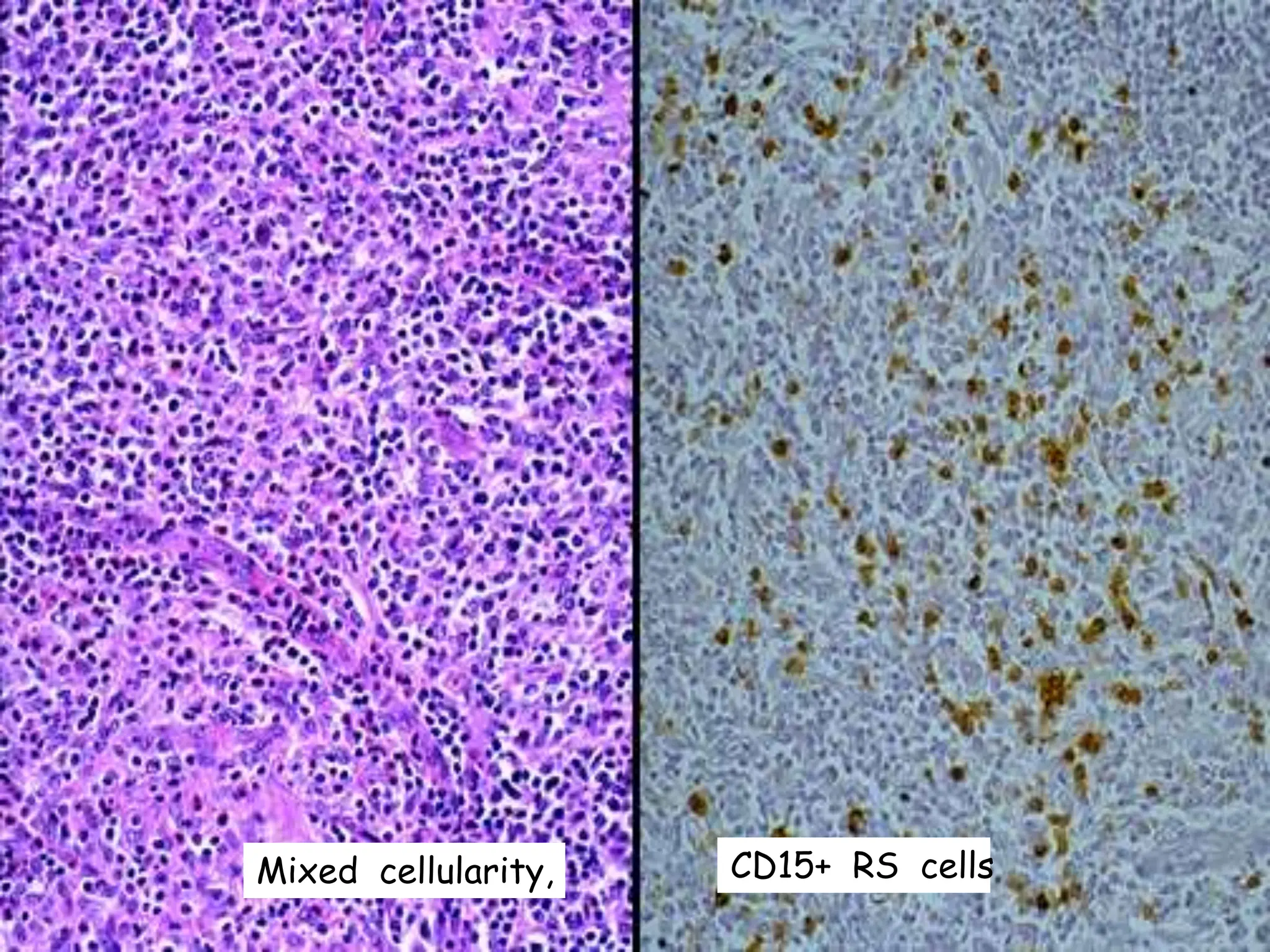 CLASSIFICATION DEFINITION & HODGKIN LYMPHOMA FOR BDS | PPT