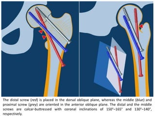 F technique for fracture neck femur | PPTX