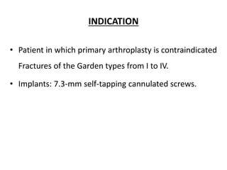 F technique for fracture neck femur | PPTX
