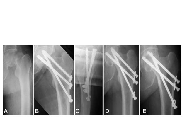 F technique for fracture neck femur | PPTX | Death, Injury, or Military ...