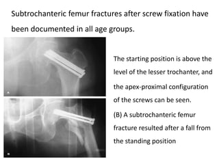 F technique for fracture neck femur | PPTX