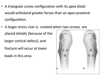 F technique for fracture neck femur | PPTX