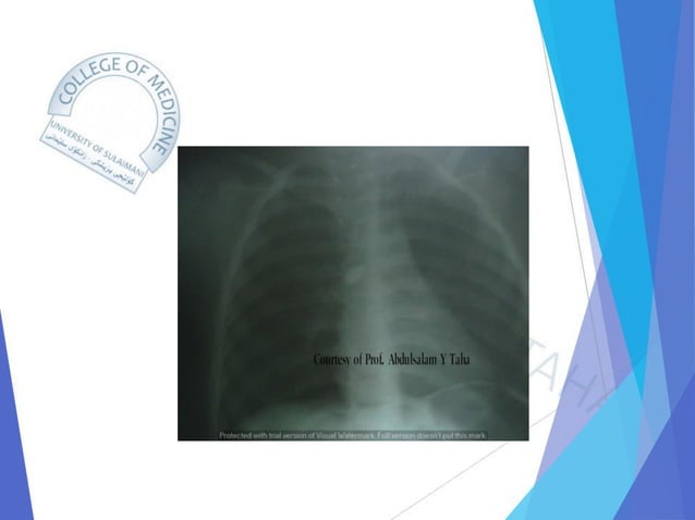 Bead in Right Main Stem Bronchus.pdf