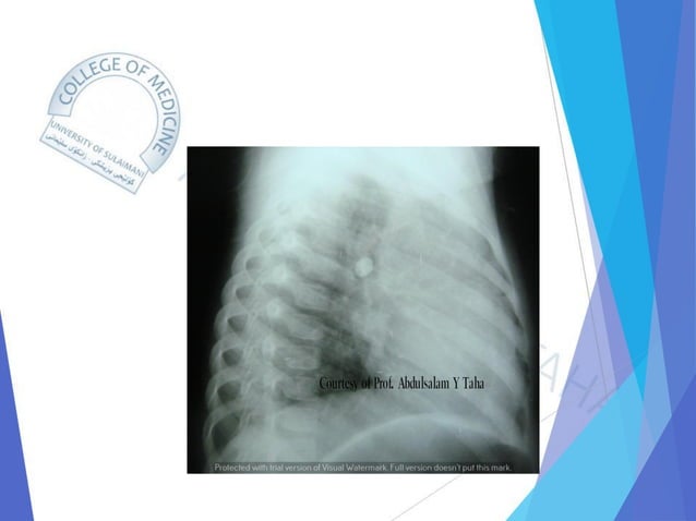 Bead in Right Main Stem Bronchus.pdf