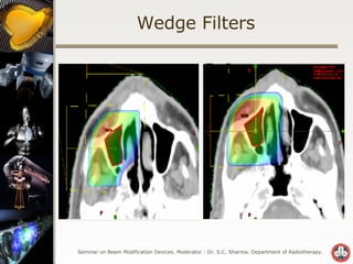 Beam Modification in Radiotherapy | PPT
