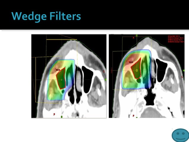Beam modification-in-radiotherapy- | PPT
