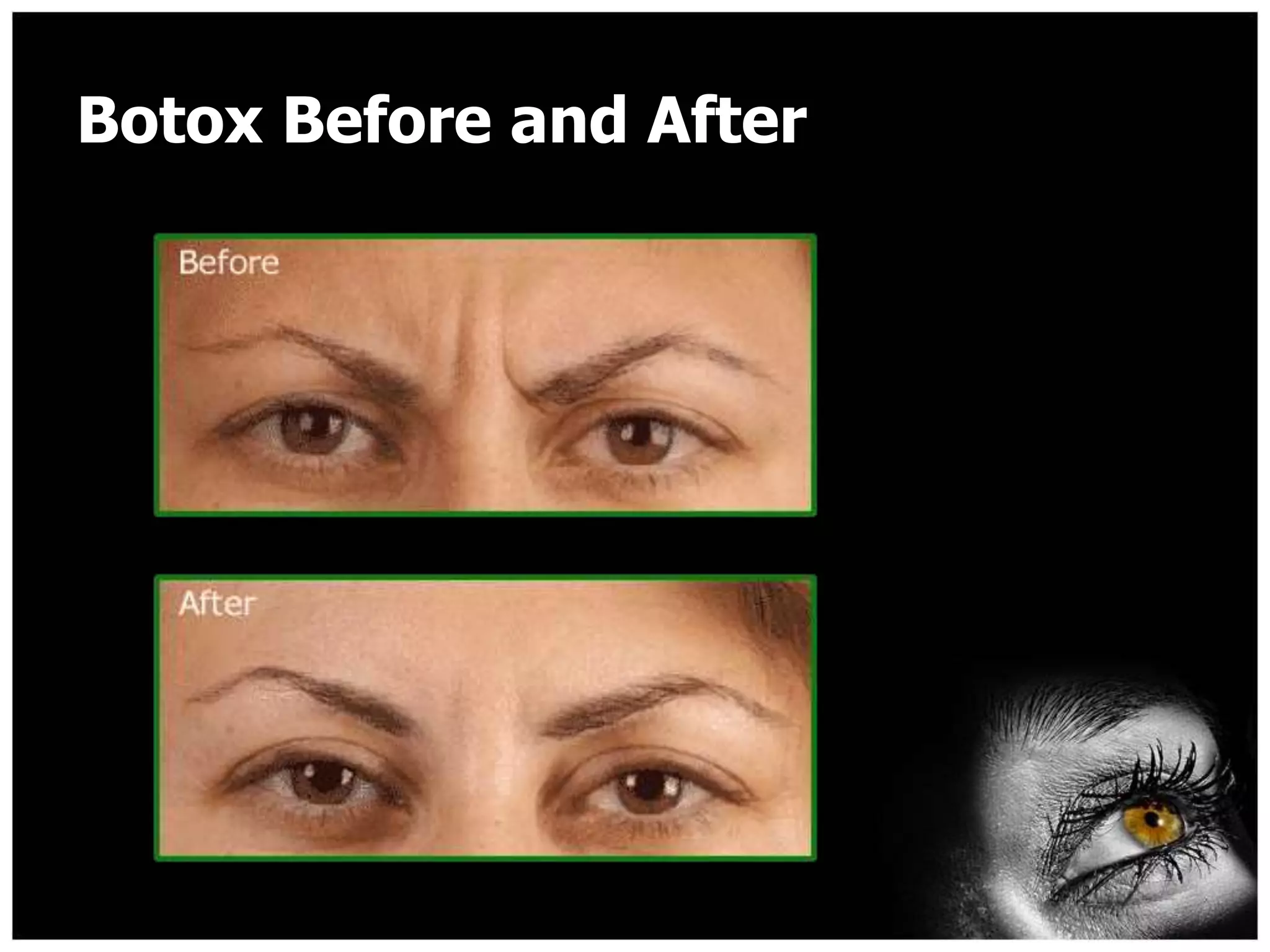 The Beauty of BOTOX | PPTX