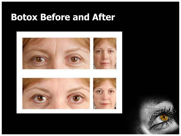 The Beauty of BOTOX | PPTX | Physical Therapy | Wellness