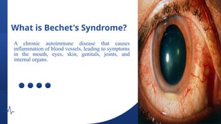 Bechet's Syndrome symptoms and its medicine.pptx