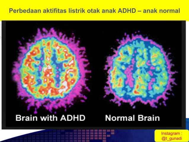 Beda antara adhd dan autis | PDF