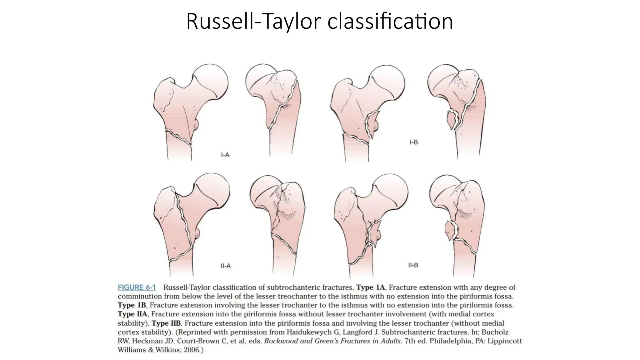 Fracture of femoral shaft and subtrochanteric | PPTX