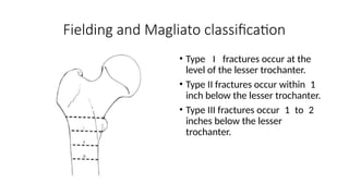 Fracture of femoral shaft and subtrochanteric | PPTX