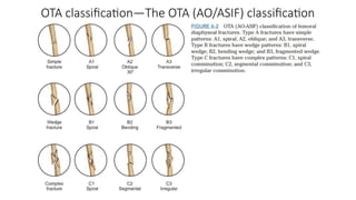 Fracture of femoral shaft and subtrochanteric | PPTX