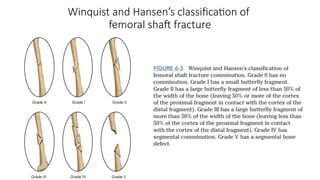 Fracture of femoral shaft and subtrochanteric | PPTX