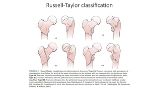 Fracture of femoral shaft and subtrochanteric | PPTX