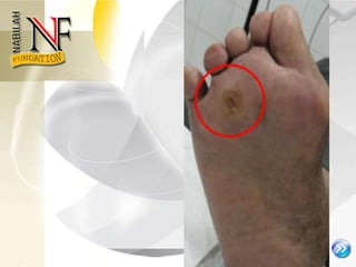 Bedah minor ; eksisi clavus | PPTX