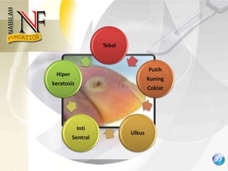 Bedah minor ; eksisi clavus | PPTX