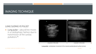 Bedside Pleural Effusion Ultrasonography: Equipment & Technique | PPSX