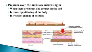 Bed sore.pptx