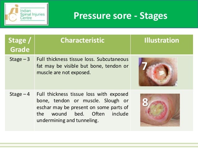 Bed Sore