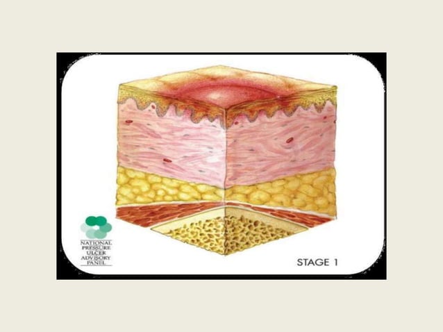 Bed sore management | PPTX