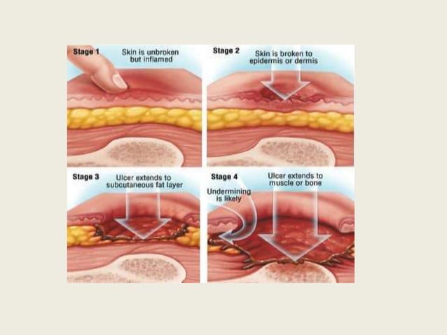 Bed sore management | PPTX