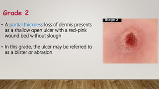 Bed sore ppt by ramniwas aiims mangala giri | PPTX