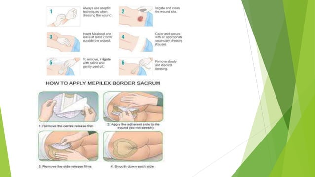 Bed Sore Pressure Ulcerspptx