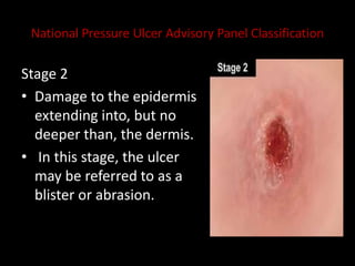 Bed Sores: Classification and Management | PPTX