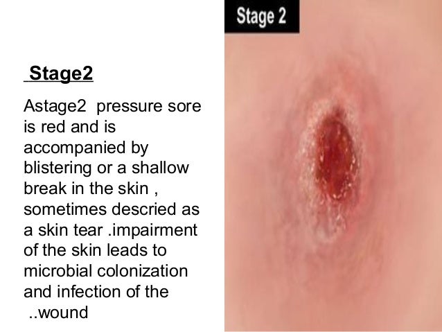 Bed Sores Pictures _ Bed Sores (Decubitus Ulcers): Stages, Causes, and ...