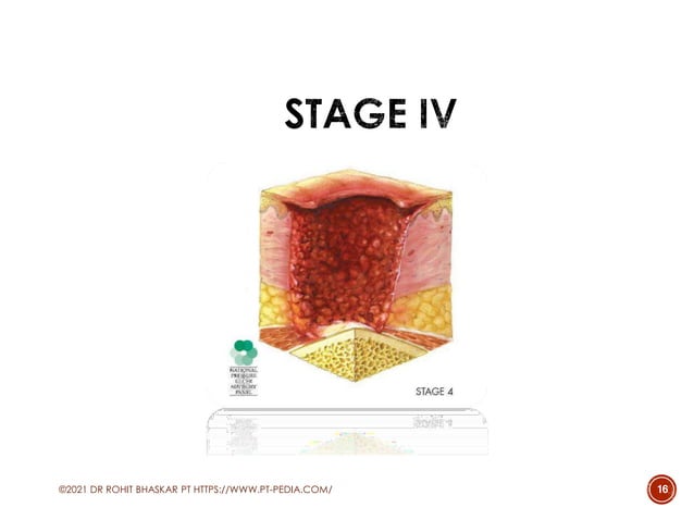 Bed Sores - Pressure Ulcers - Dr Rohit Bhaskar | PDF | Skin and ...
