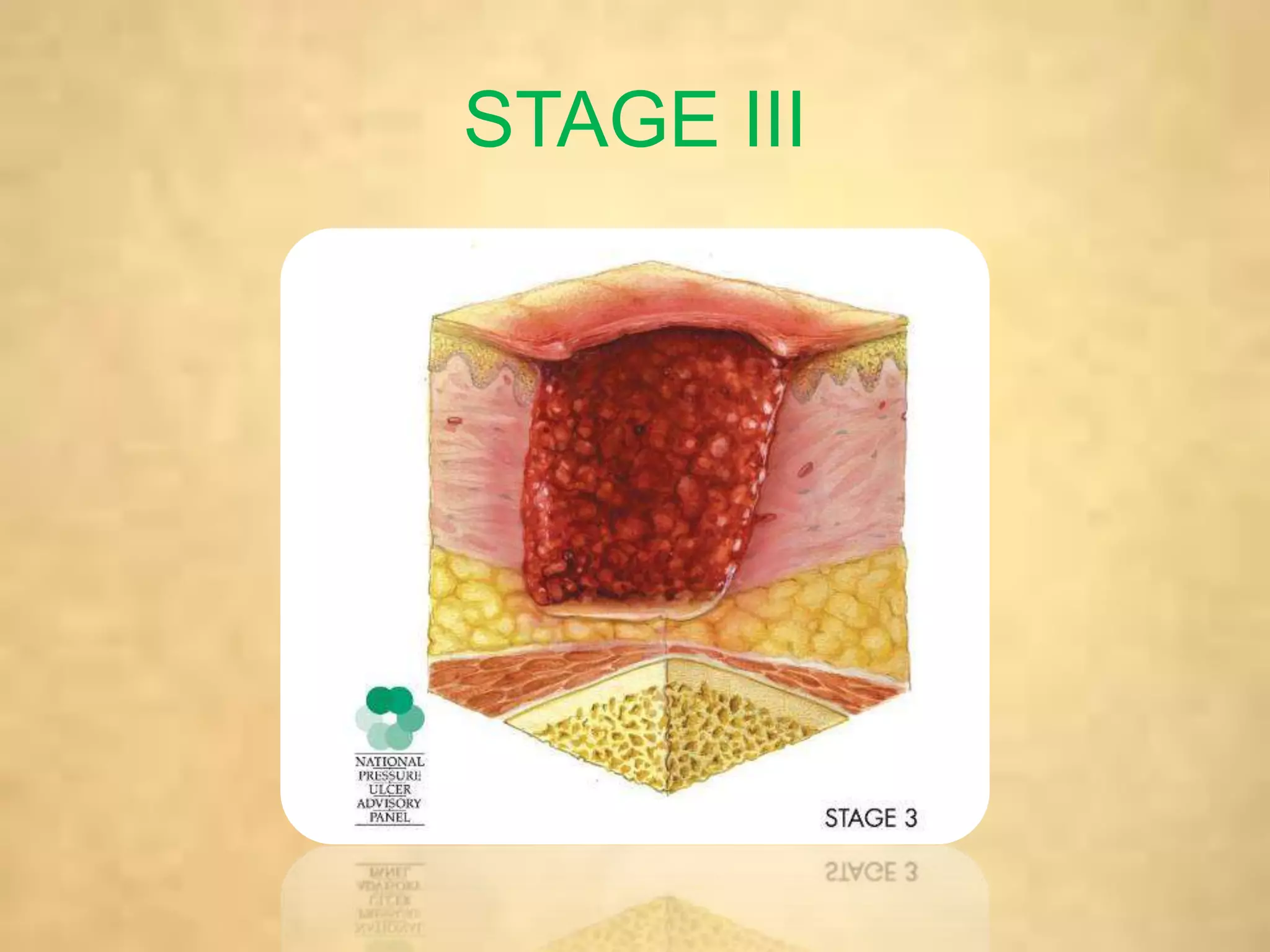 Bed sores / decubitis ulcer / pressure sores | PPTX