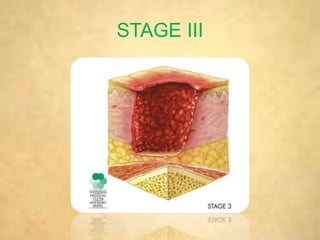 Bed sores / decubitis ulcer / pressure sores | PPTX