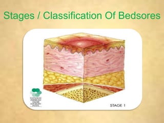 Bed sores / decubitis ulcer / pressure sores | PPTX