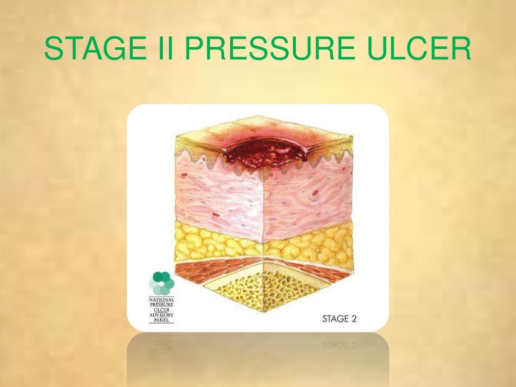 Bed Sores Decubitis Ulcer Pressure Sores