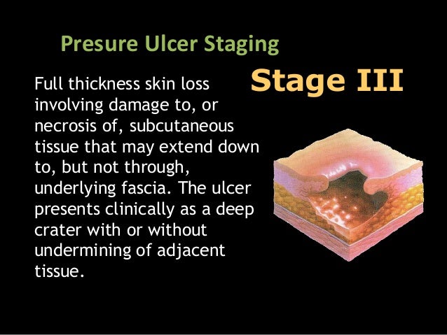 Bed sore stages