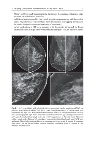 Management of Early Stage Breast Cancer | PDF