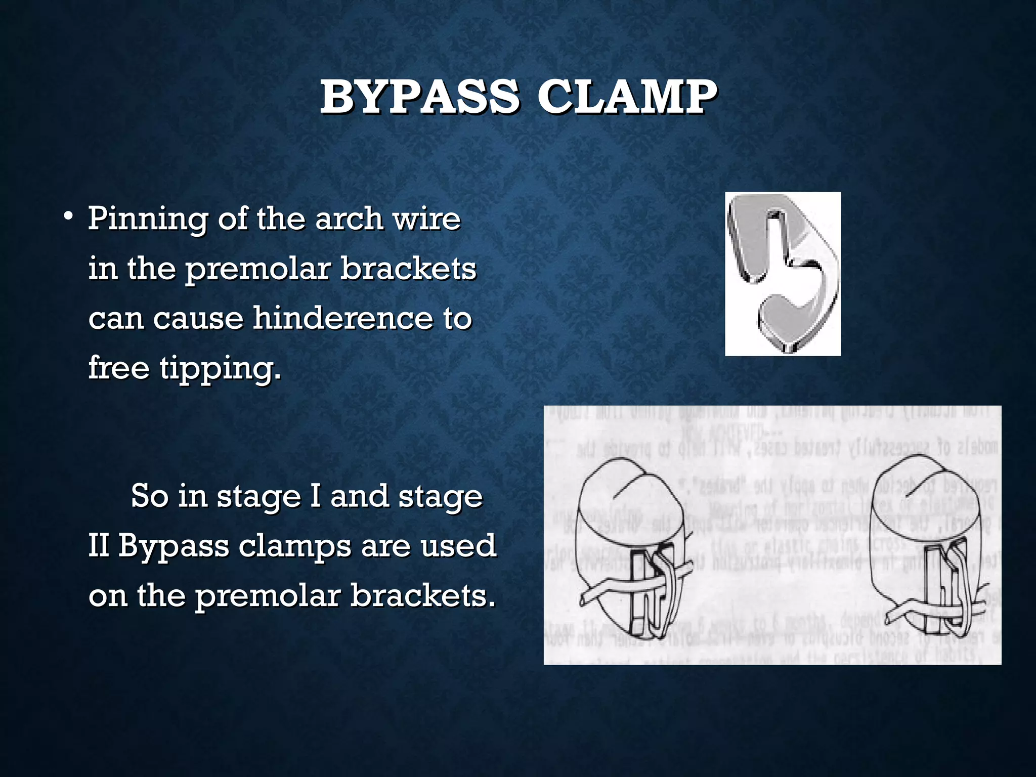 Begg’s philosophy and technique | PPT