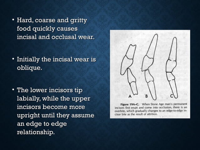 Begg’s philosophy and technique | PPT | Oral care | Personal Care