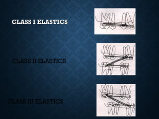 Begg’s philosophy and technique | PPT