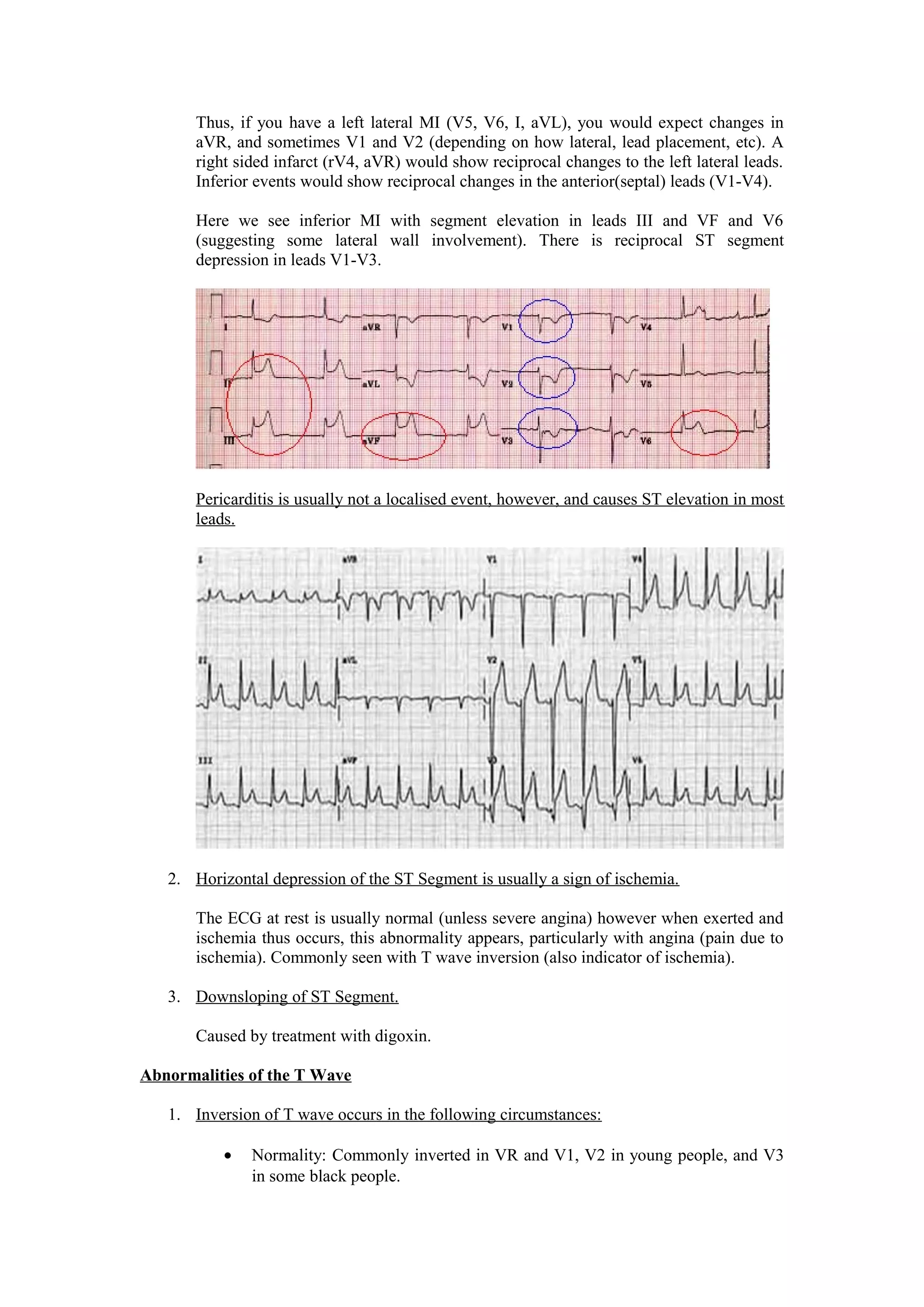 Beginners Guide for ECG Interpretation | DOC | Heart and Cardiovascular Diseases | Diseases and ...