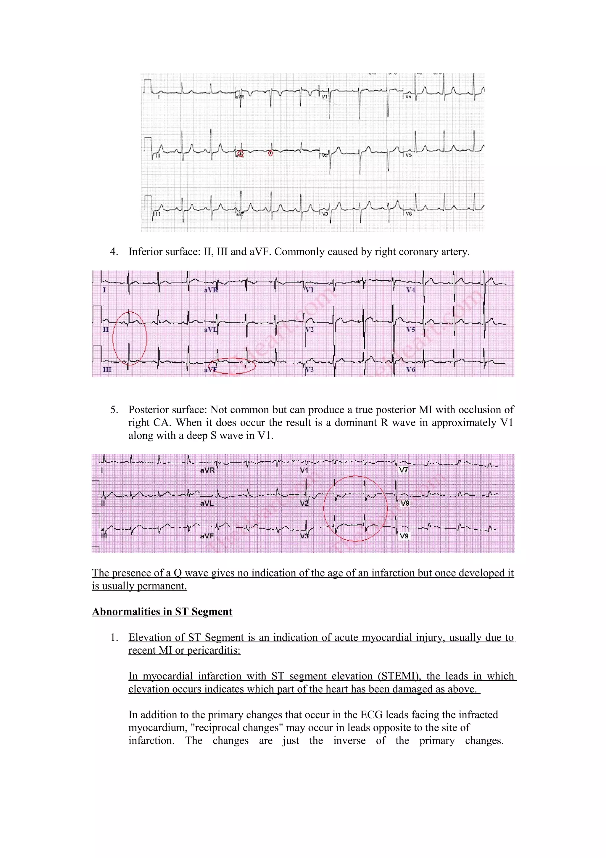 Beginners Guide for ECG Interpretation | DOC | Heart and Cardiovascular Diseases | Diseases and ...