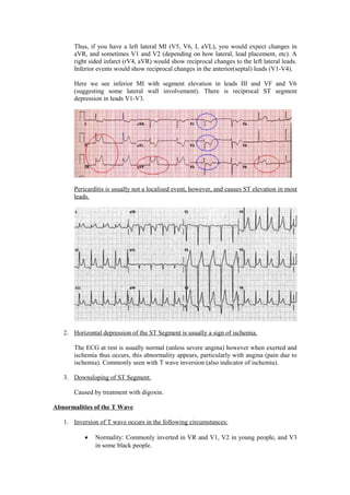 Beginners Guide for ECG Interpretation | DOC | Heart and Cardiovascular ...