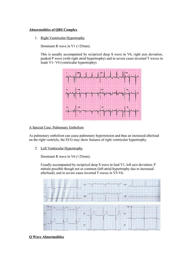 Beginners Guide for ECG Interpretation | DOC | Heart and Cardiovascular ...