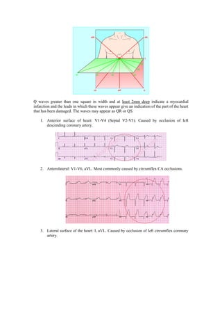 Beginners Guide for ECG Interpretation | DOC | Heart and Cardiovascular Diseases | Diseases and ...