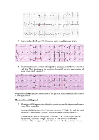 Beginners Guide for ECG Interpretation | DOC | Heart and Cardiovascular Diseases | Diseases and ...
