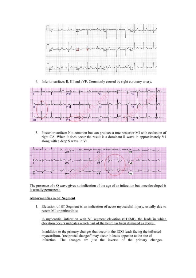 Beginners Guide for ECG Interpretation | DOC | Heart and Cardiovascular ...